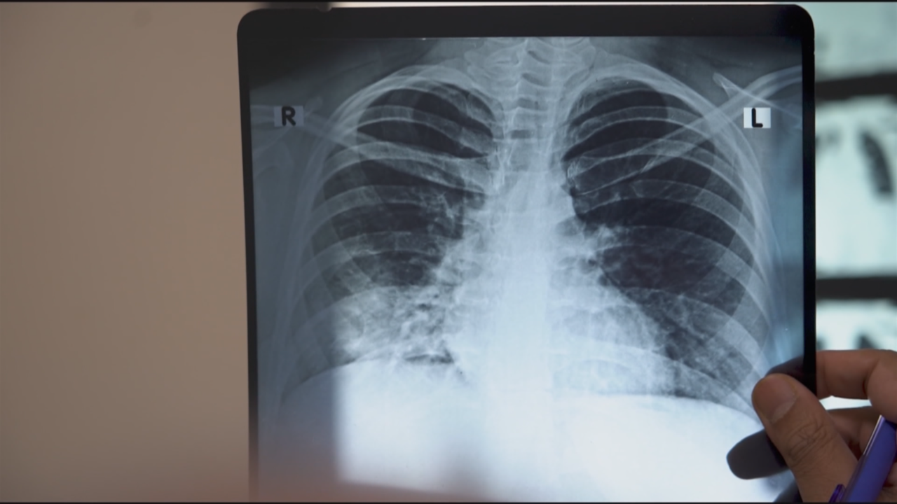 World Tuberculosis Day: India's endless war against TB - Focus